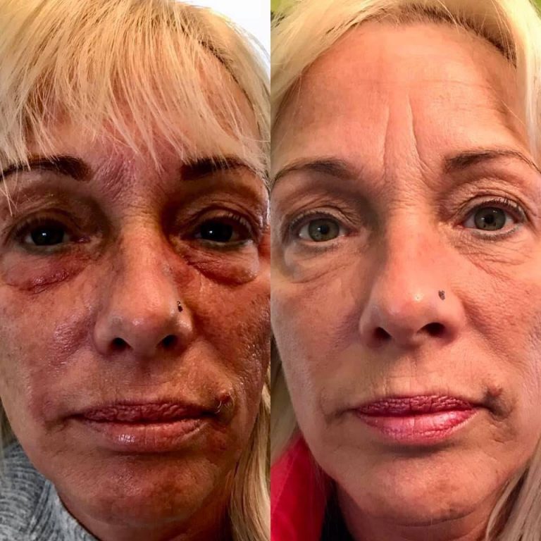 SuneKos in Bedford Skin Rejuvenation - Clarity Cosmetics